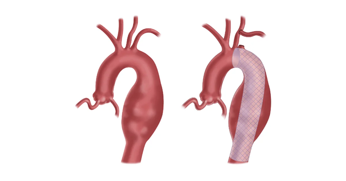 TEVAR Procedure in Ahmedabad | EPIC Hospital